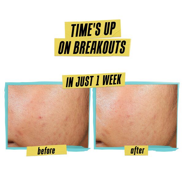 Expertly Clear Blemish-Treating Preventing Lotion